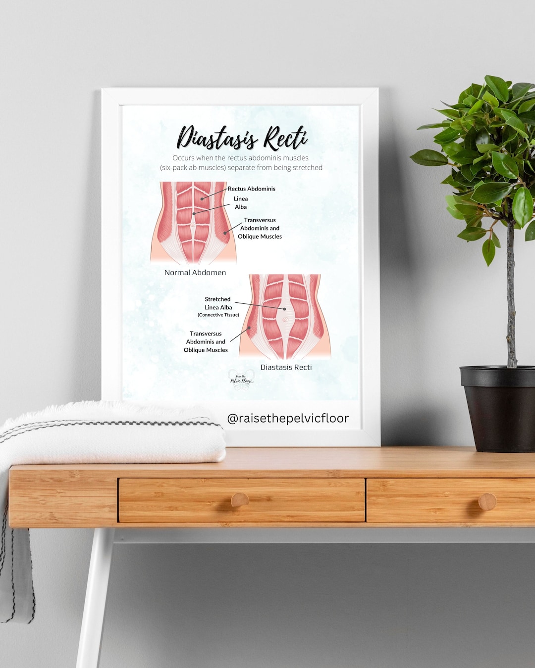 Diastasis Recti Pelvic Floor Art Poster | Postpartum, Pregnancy, Pelvic ...