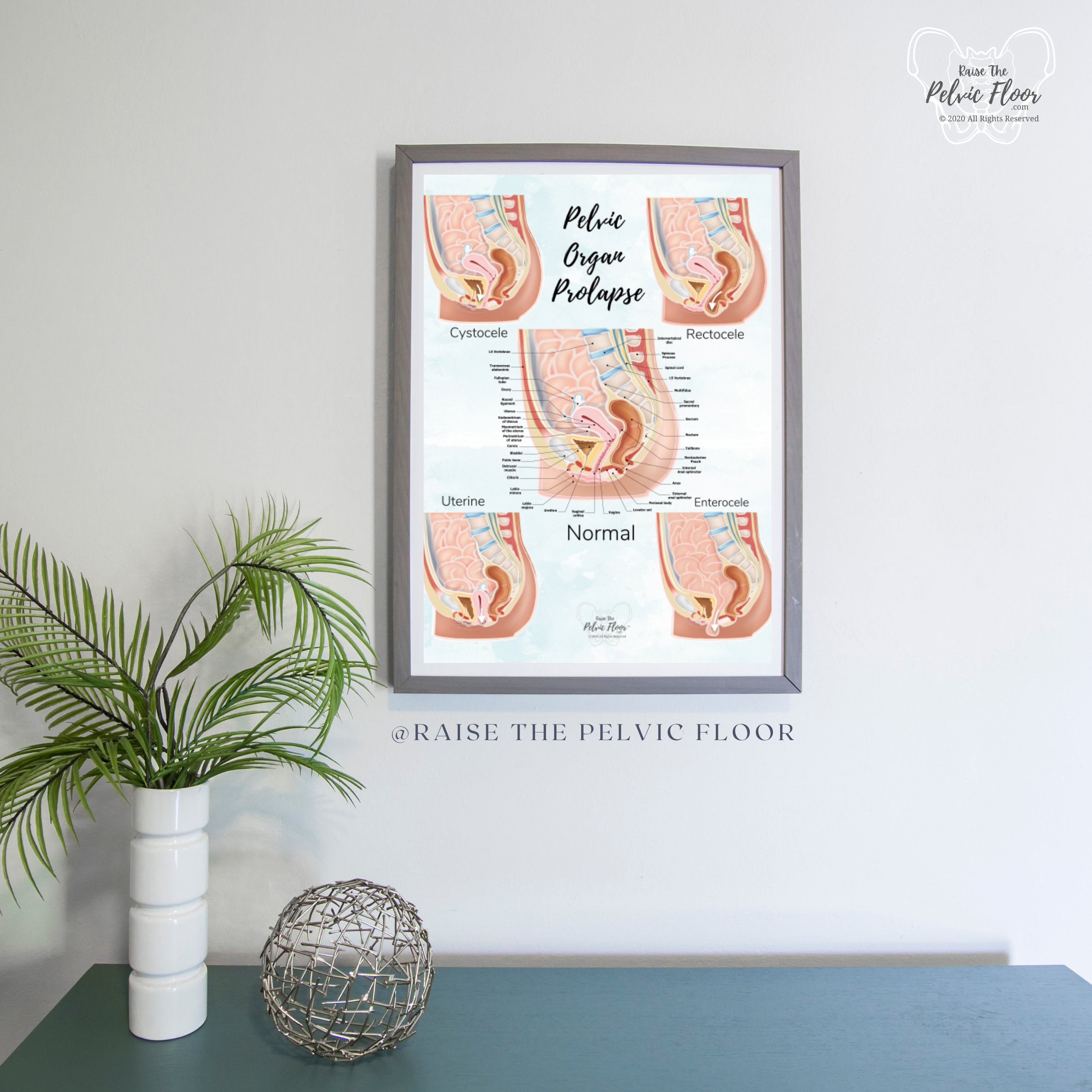 Prolapse Bladder, Rectum, Uterus, Intestine Art Print | Cystocele ...