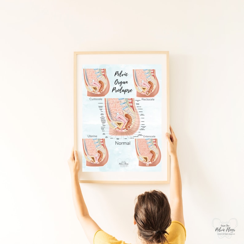 Prolapse Bladder, Rectum, Uterus, Intestine Art Print | Cystocele ...