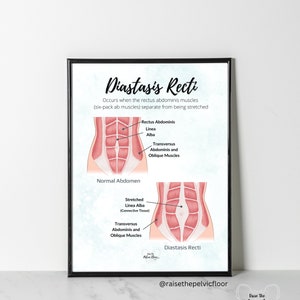 Diastasis Recti Pelvic Floor Art Poster | Postpartum, Pregnancy, Pelvic ...