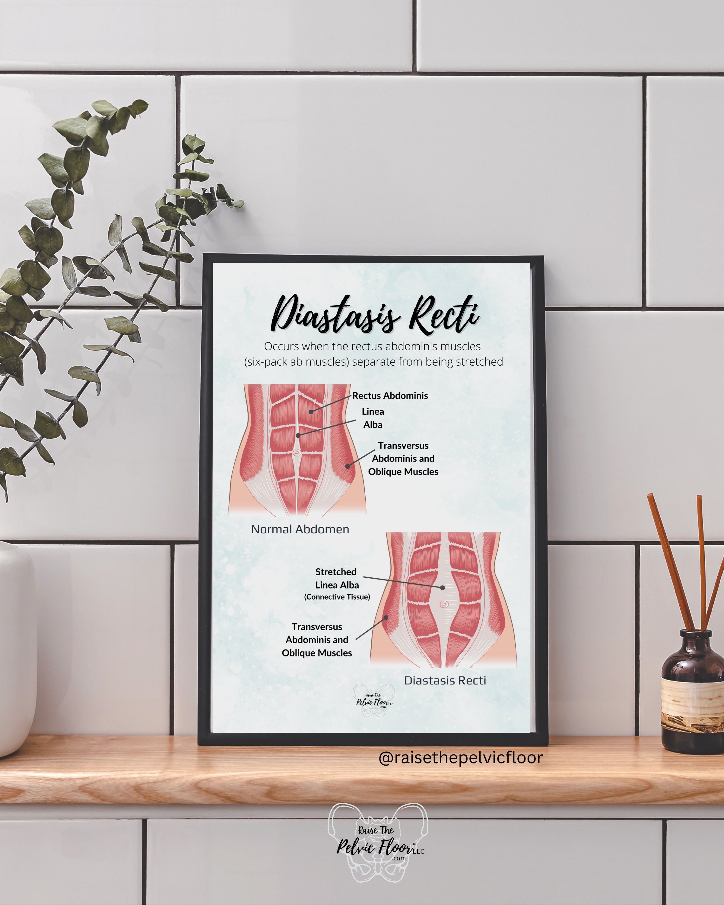 Diastasis Recti Pelvic Floor Art Poster Postpartum - Etsy