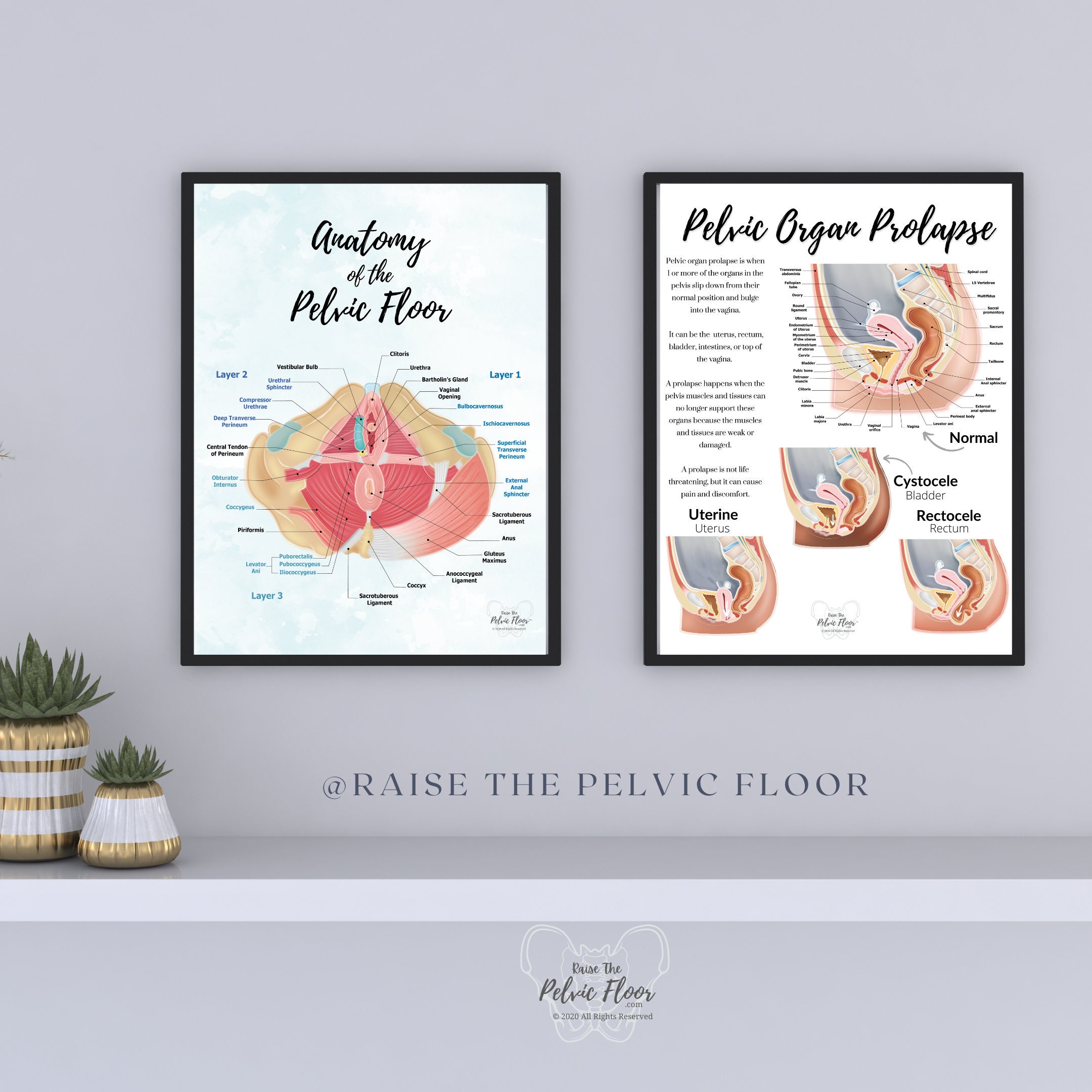 Prolapse Definition Art Print of Bladder, Rectum, & Uterus Cystocele ...