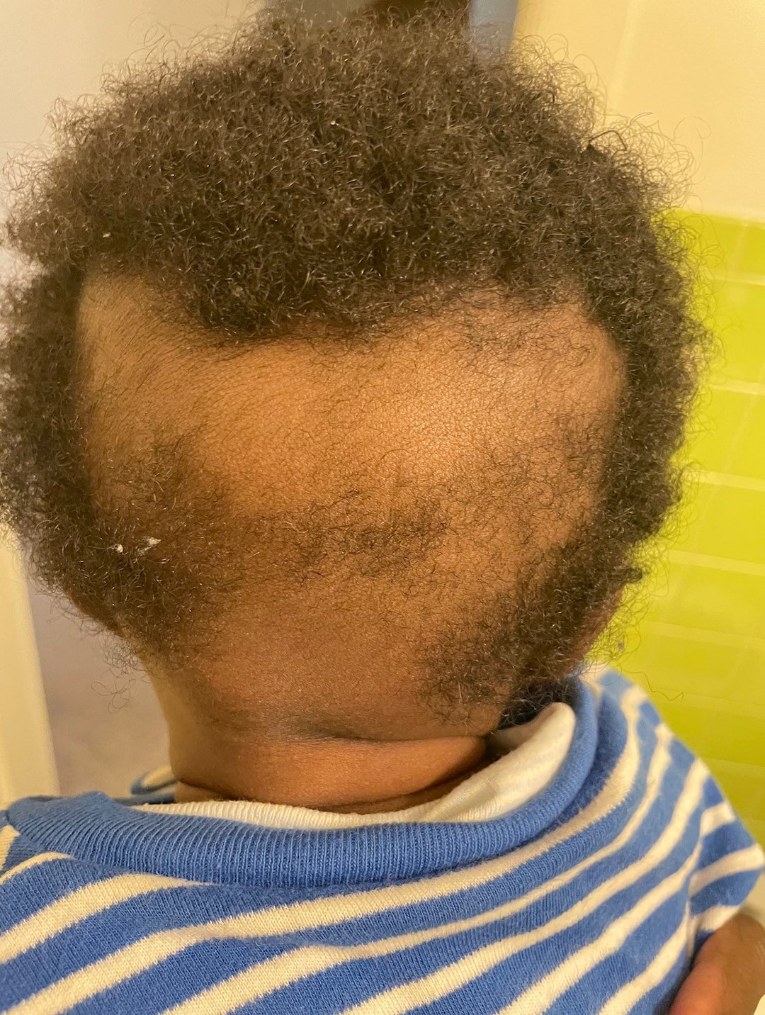 Cradle Cap Black Babies