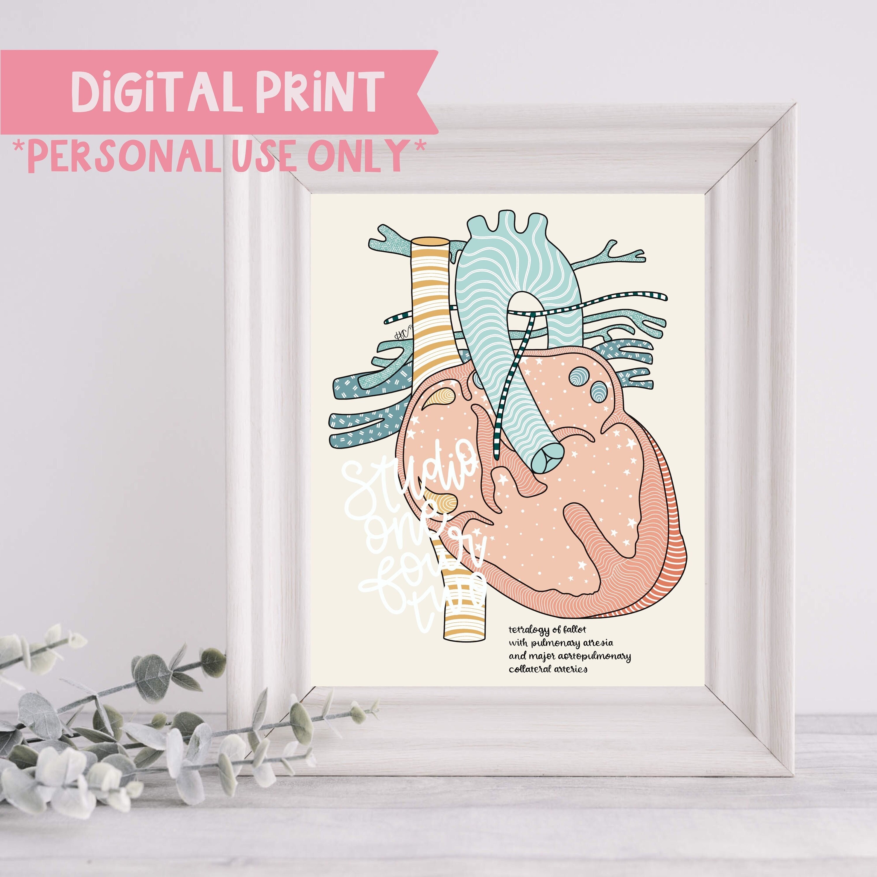 TOF With MAPCAS Anatomical Heart Illustration Digital Print Only CHD ...