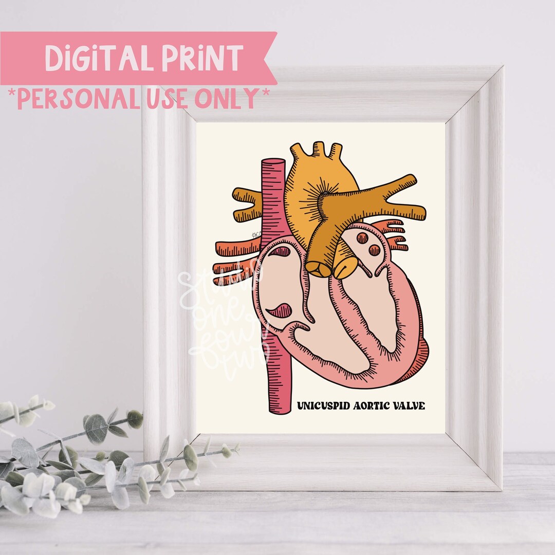 Unicuspid Aortic Valve Digital Print | Anatomical Heart Illustration ...