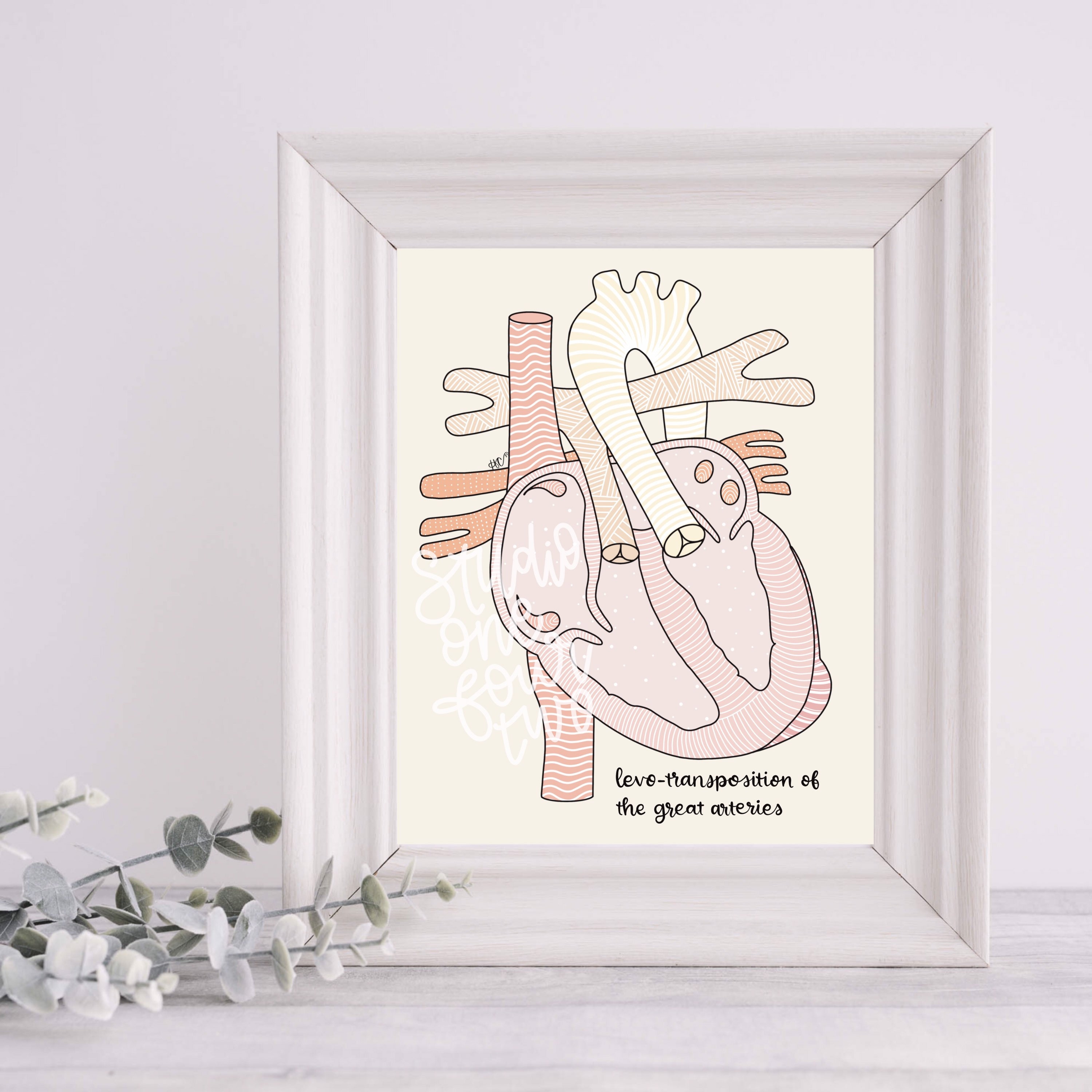 L-tga Art Print CHD Art Print Physical Print Heart | Etsy