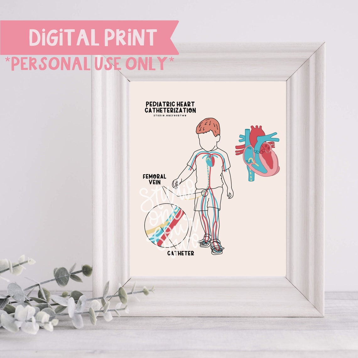 Pediatric Heart Catheterization Digital Print | Anatomical Heart ...