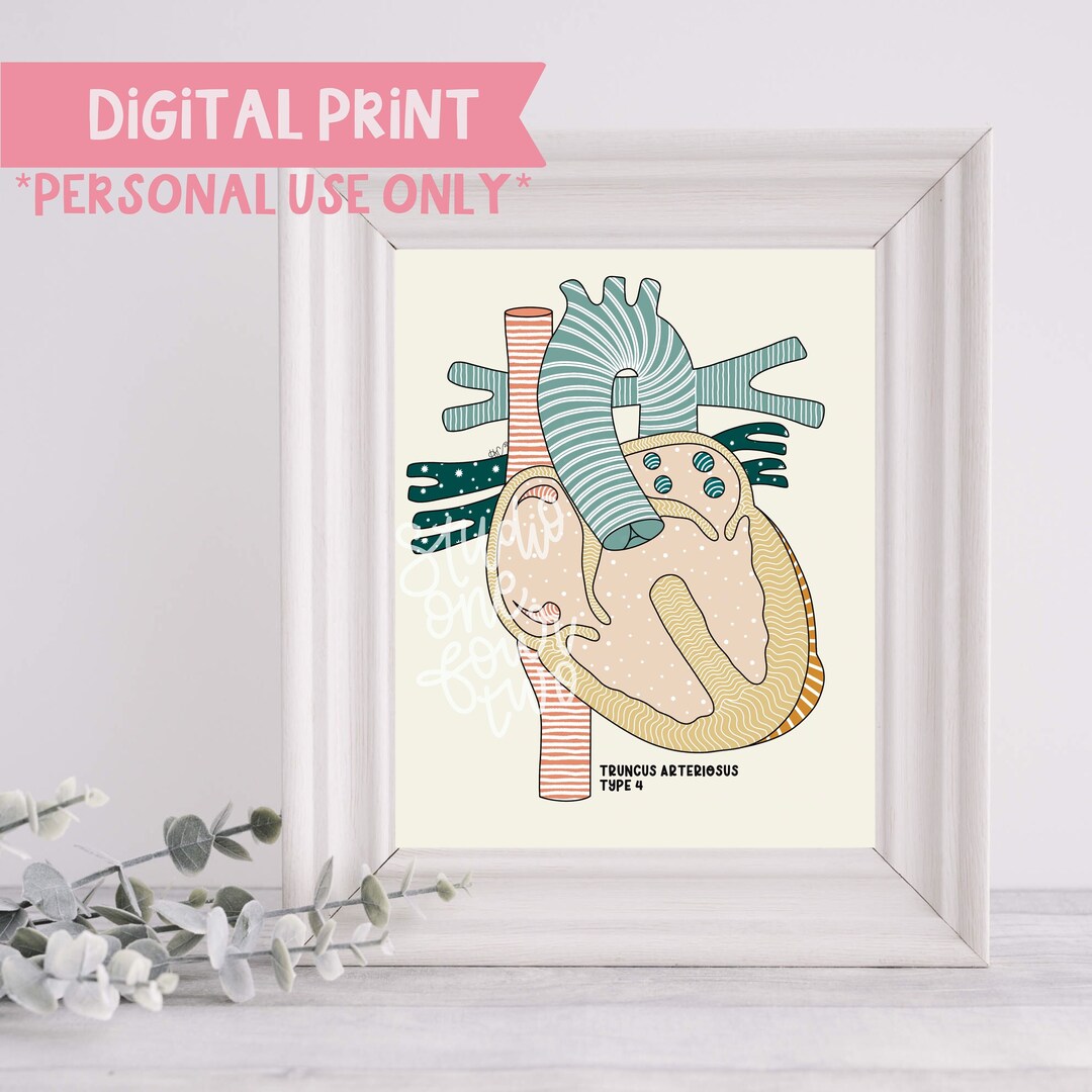 Truncus Arteriosus Type 4 Digital Print | Anatomical Heart Illustration ...