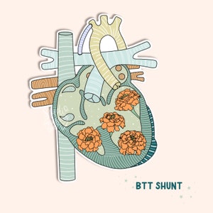 DILV Single Ventricle Surgery Series Stickers | Double Inlet Left ...