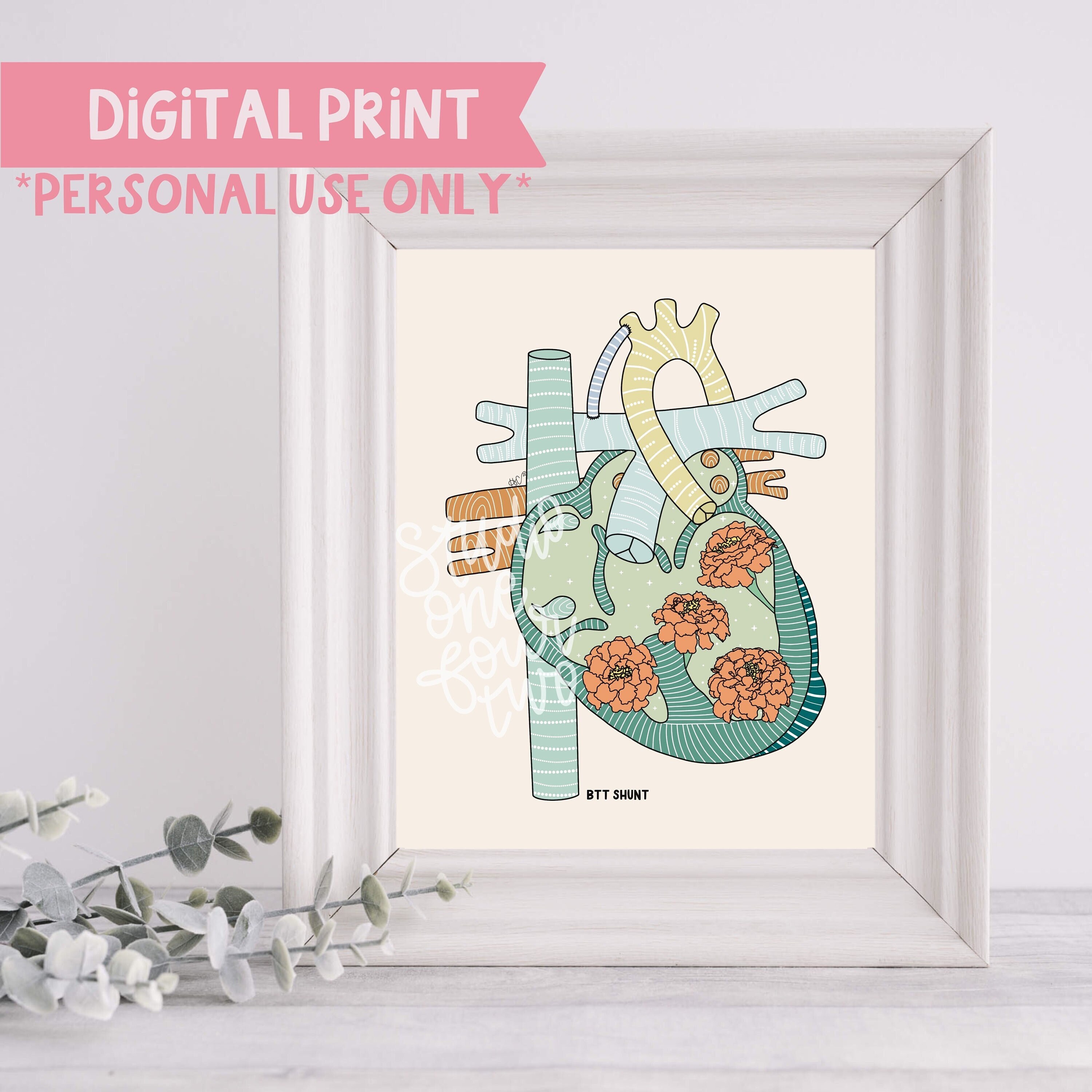 Double Inlet Left Ventricle