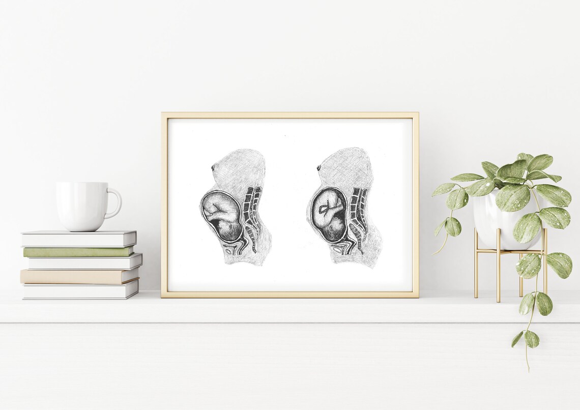 Posterior and Anterior Fetal Presentations: Birth/doula/midwife Art ...
