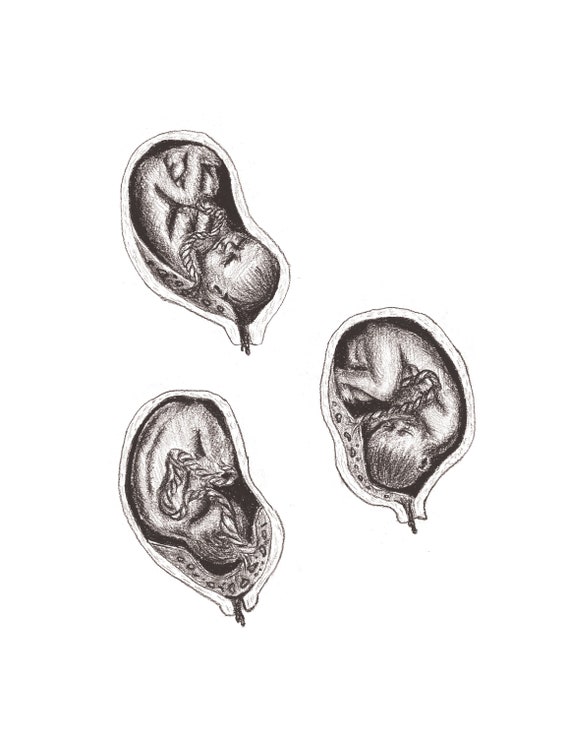 Placenta Previa Illustrations Set of Two | Etsy