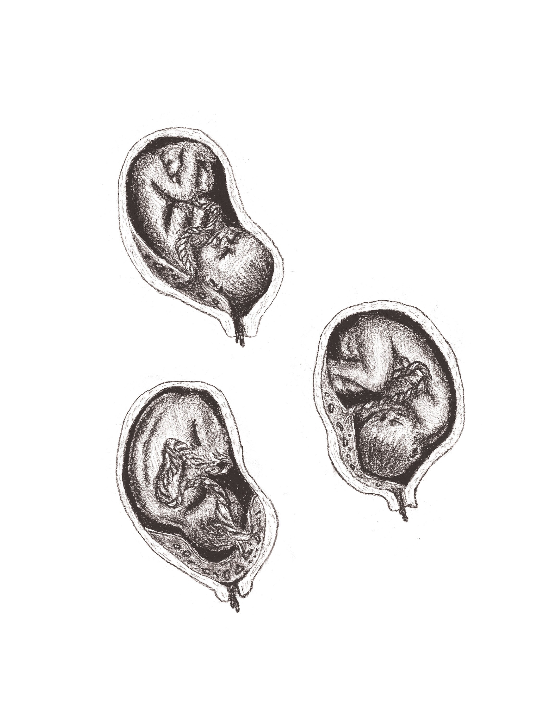 Placenta Previa Illustrations Set of Two: Birth/doula/midwife Art ...