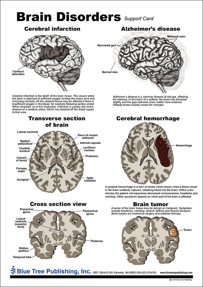 Brain Disorders Anatomical Chart - Etsy