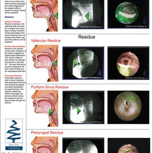 Swallowing Disorders Anatomical Chart - Etsy