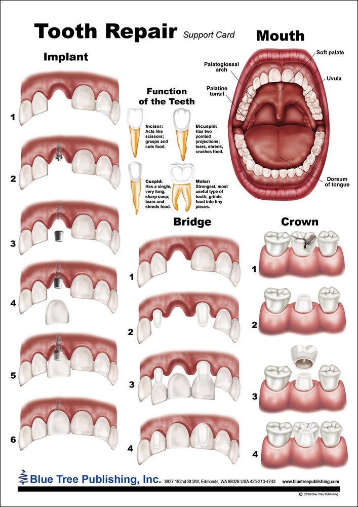 Tooth Repair Anatomical Chart - Etsy