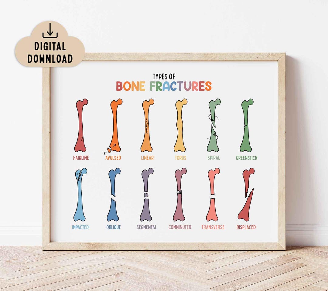 Bone Fractures Poster, Broken Bone Illustration, BRIGHT Colors (digital ...
