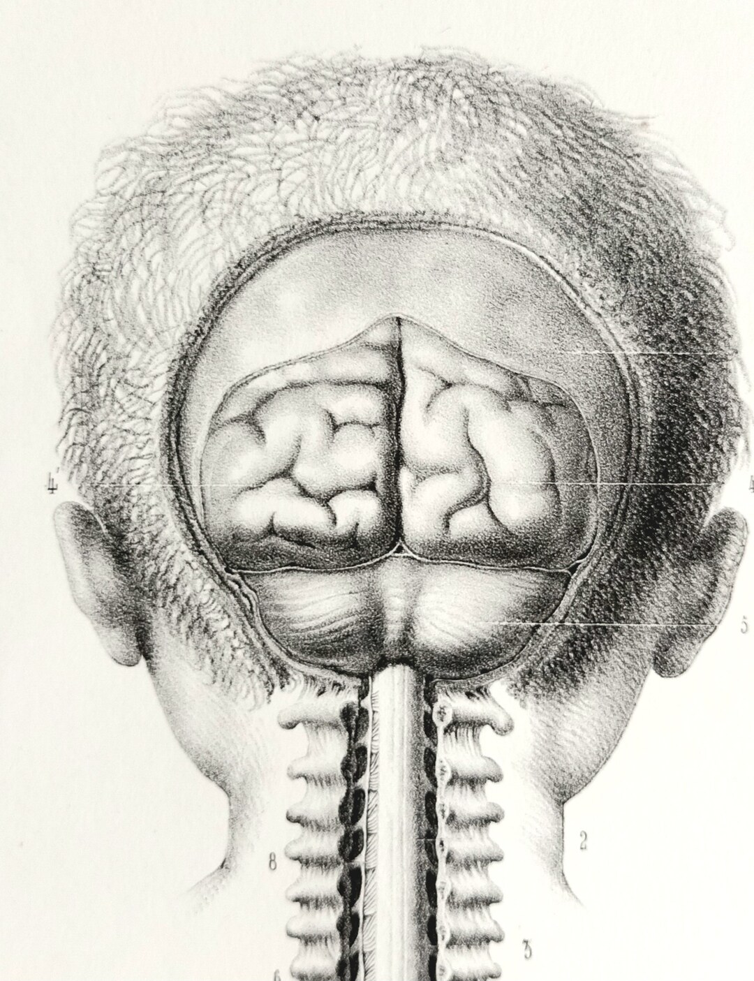 Original Lithograph From the 19th Century Anatomy, Fetal Dissection ...