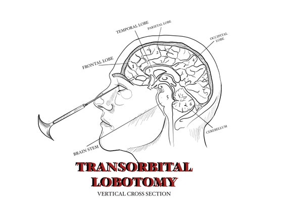 Lobotomy Diagram