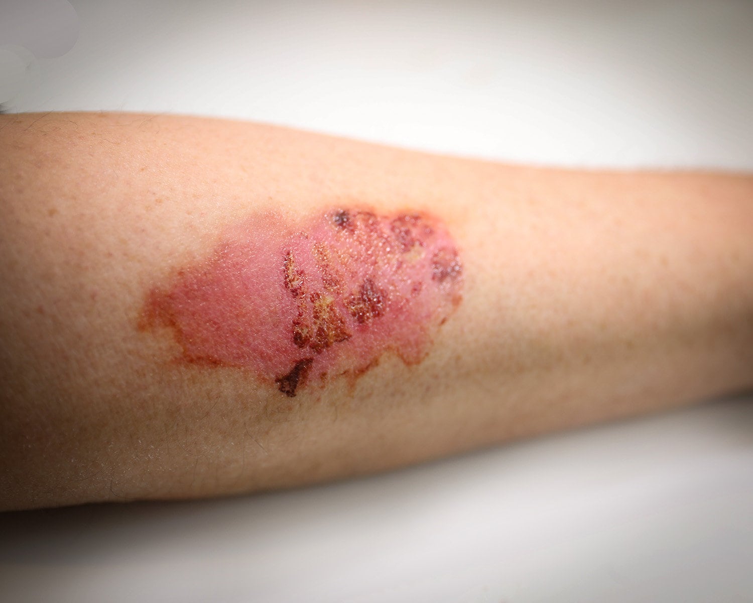 Temporary Tattoo - Burn Wounds - SFX Tattoo - Etsy