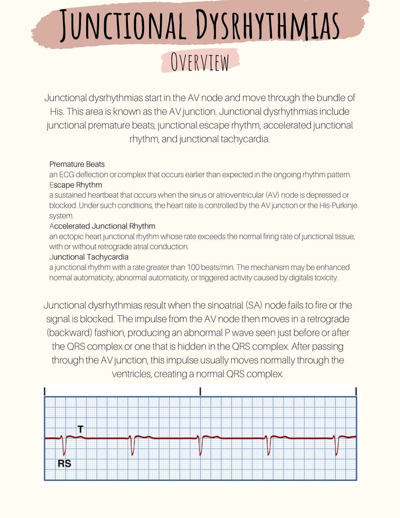 Junctional Dysrhythmias - Etsy