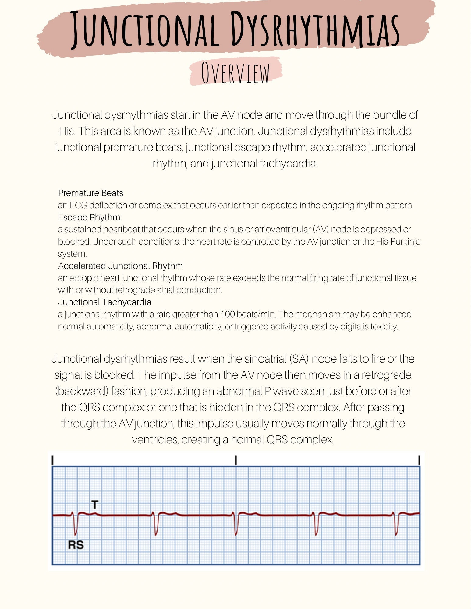 Junctional Dysrhythmias - Etsy