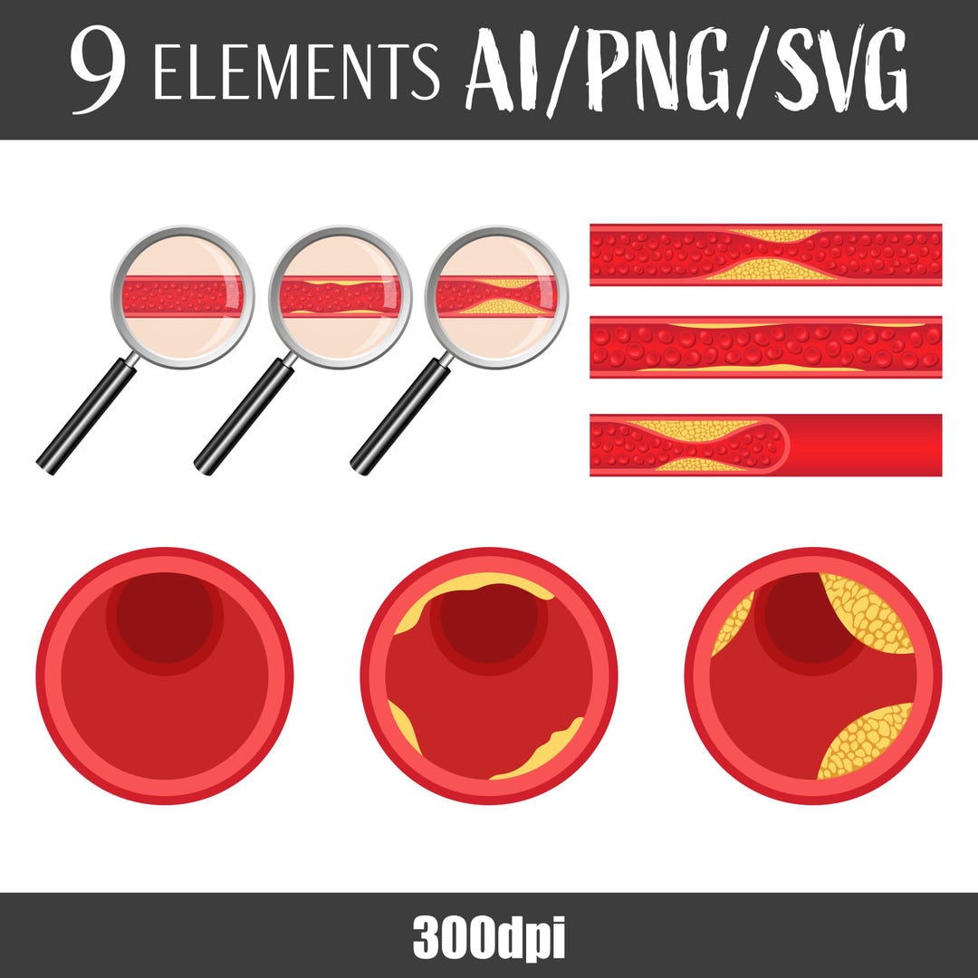 Atherosclerosis Clipart Design Artwork Medical Illustration Sketch ...