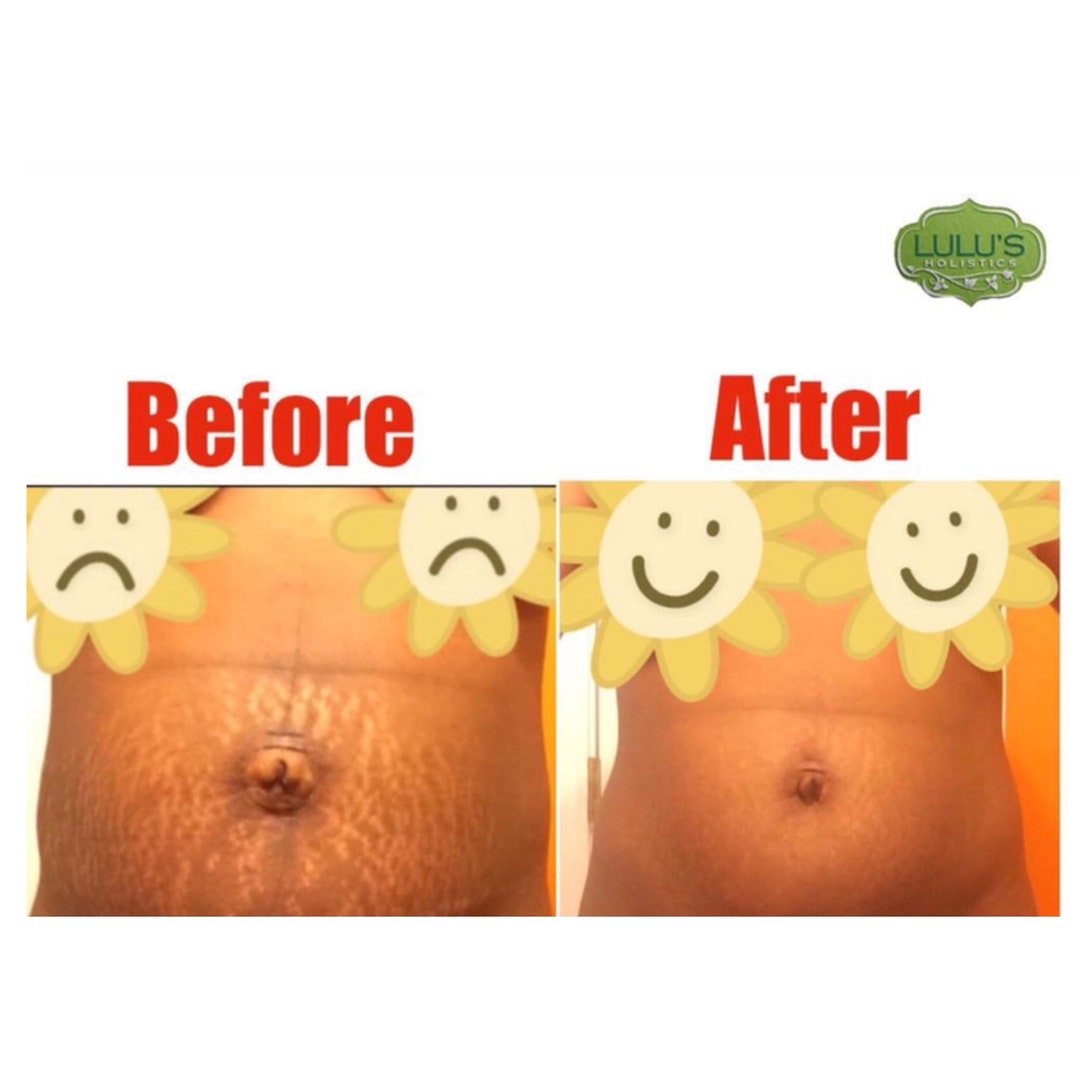 Stretch Mark Remover - Etsy