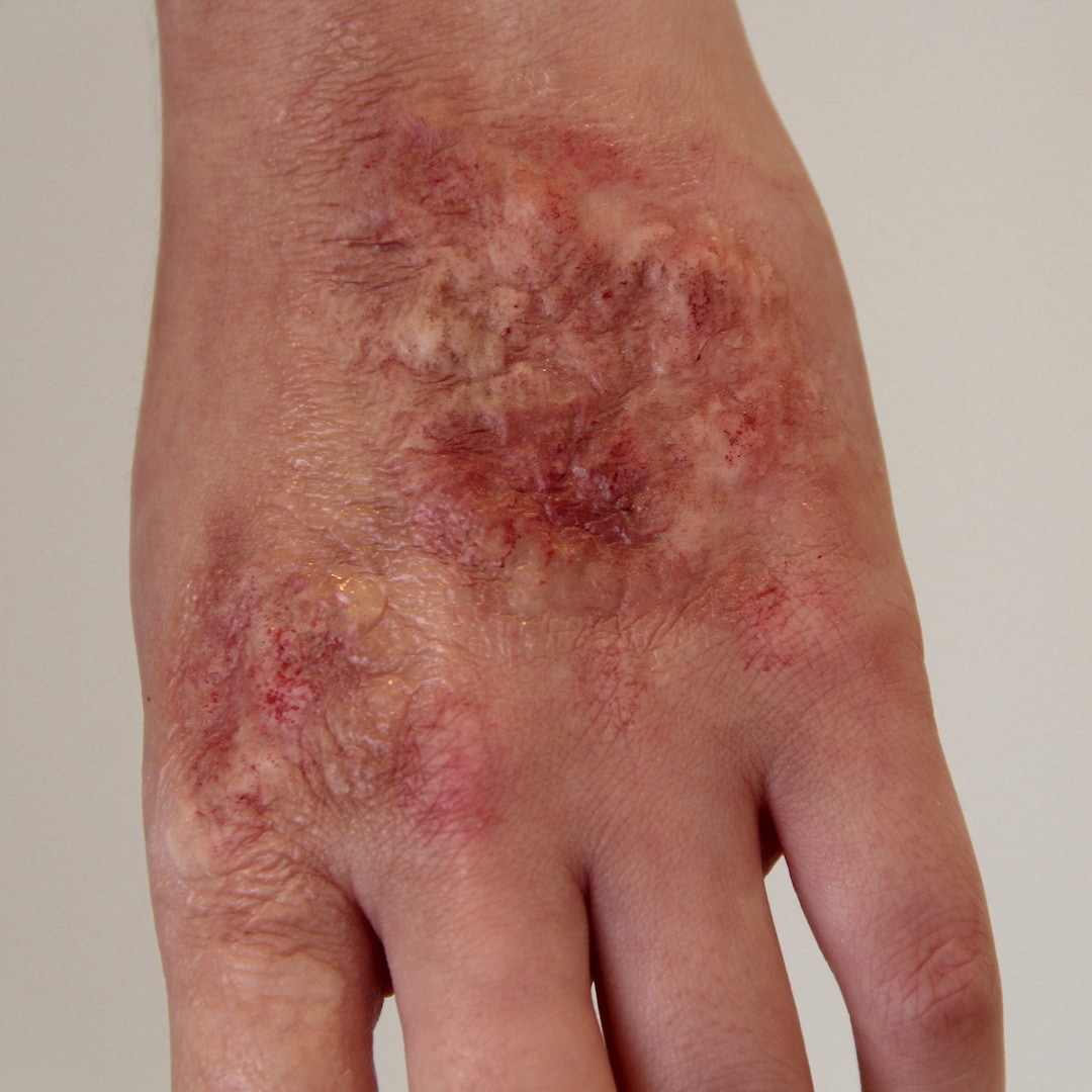 Burn Mark / Acid or Chemical Wound SFX Silicone Prosthetic Makeup ...