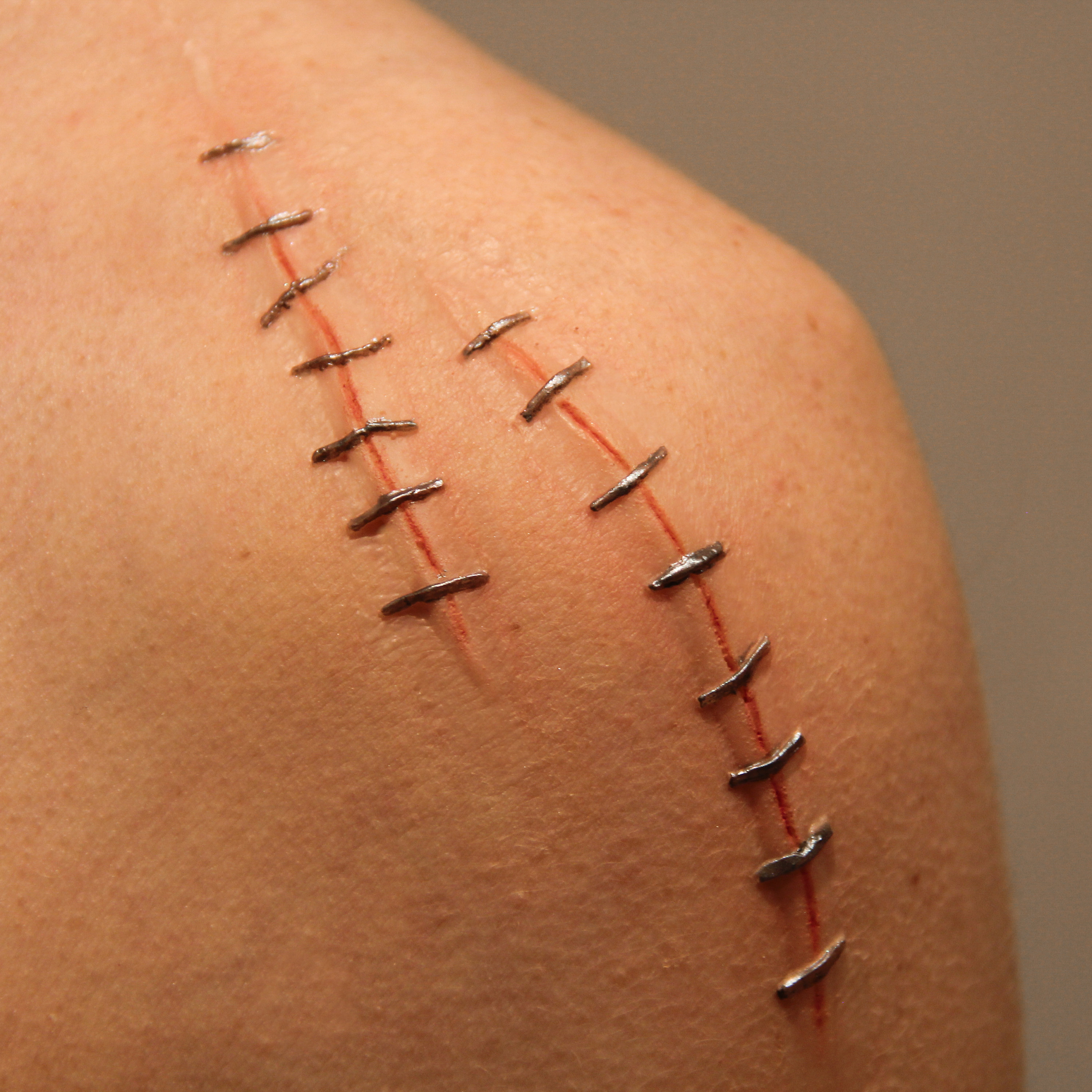 Forearm Stitches