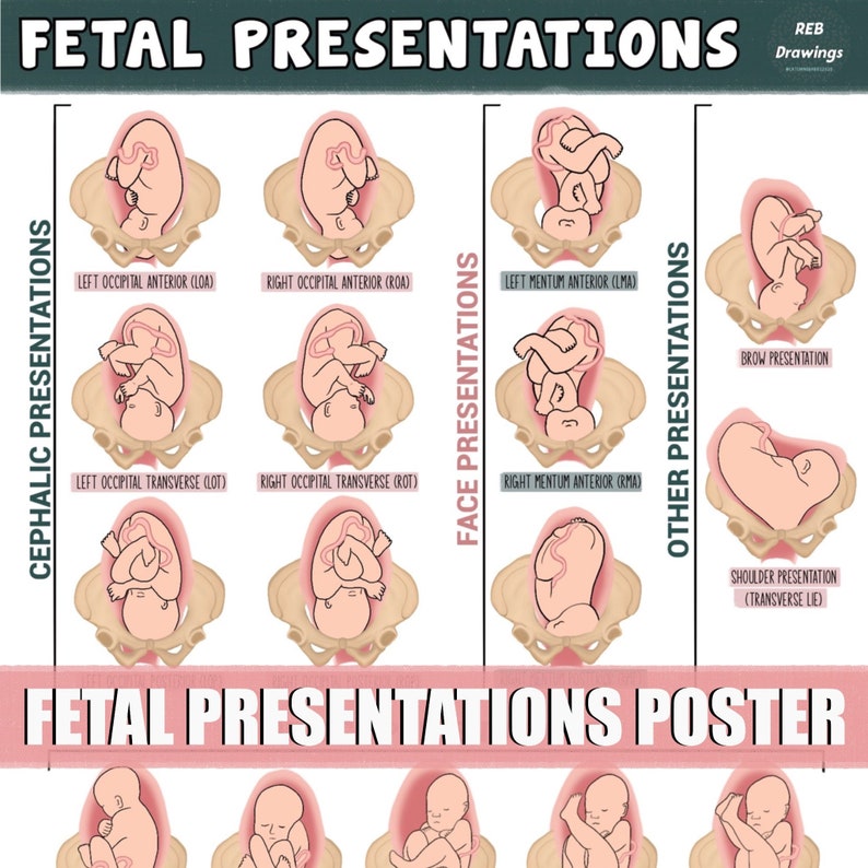 Fetal Presentations Poster - Etsy