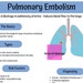 Pulmonary Embolism or PE Nursing School Notes, Med Surg Pulmonary ...