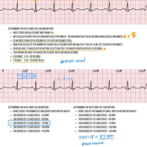 38 Pages Easy EKG and Master the Basics Like Heart Blocks, Help With Junctional Rhythms ...