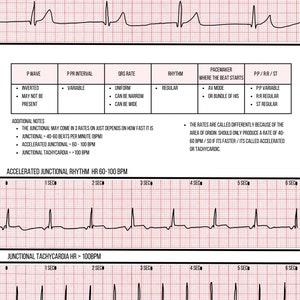 38 Pages Easy EKG and Master the Basics Like Heart Blocks, Help With Junctional Rhythms ...