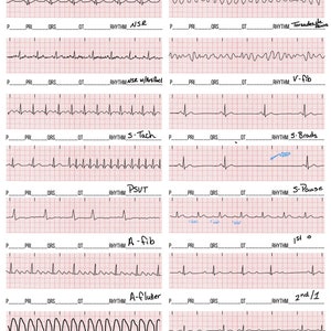 38 Pages Easy EKG and Master the Basics Like Heart Blocks, Help With Junctional Rhythms ...