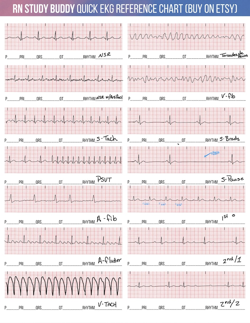 38 Pages Easy EKG and Master the Basics Like Heart Blocks - Etsy