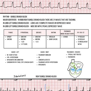 38 Pages Easy EKG and Master the Basics Like Heart Blocks, Help With Junctional Rhythms ...