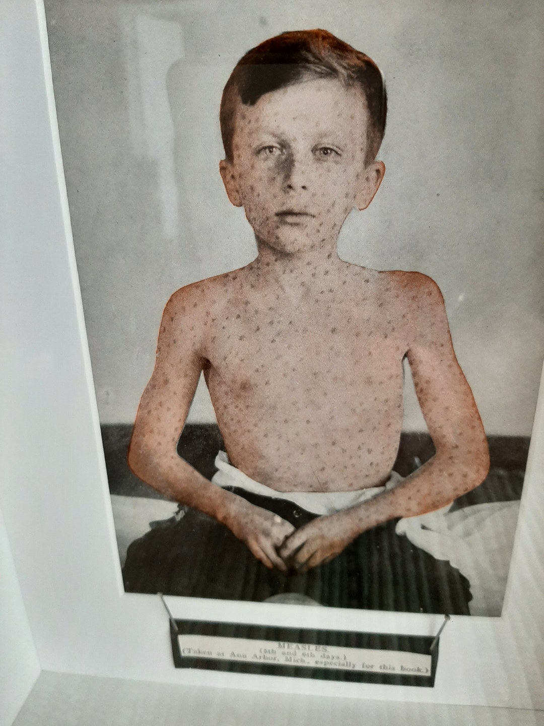 Vintage Medical Themed Art Measles Authentic Vintage Medical Image of ...