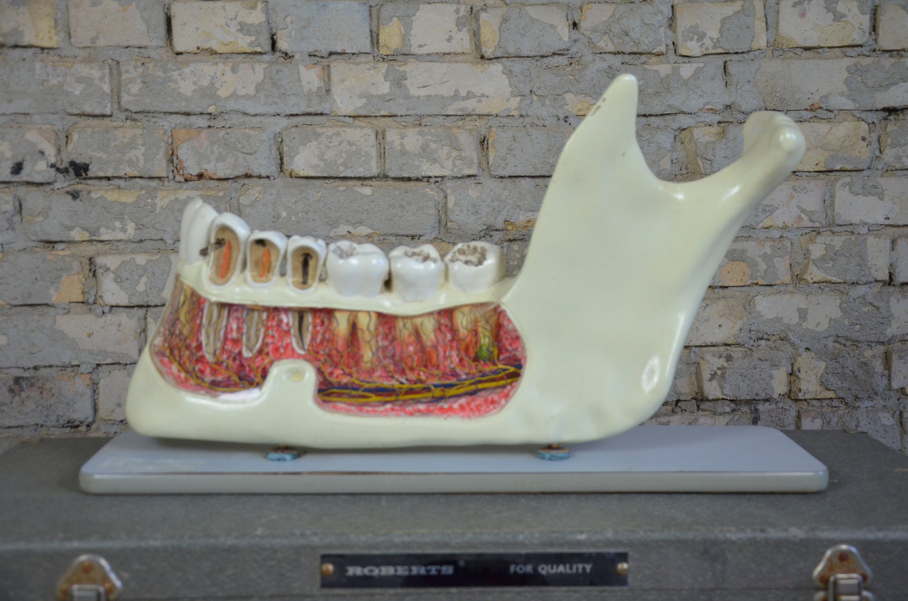 Giant Human Jaw Tooth Decay: Vintage Anatomical Model - Etsy