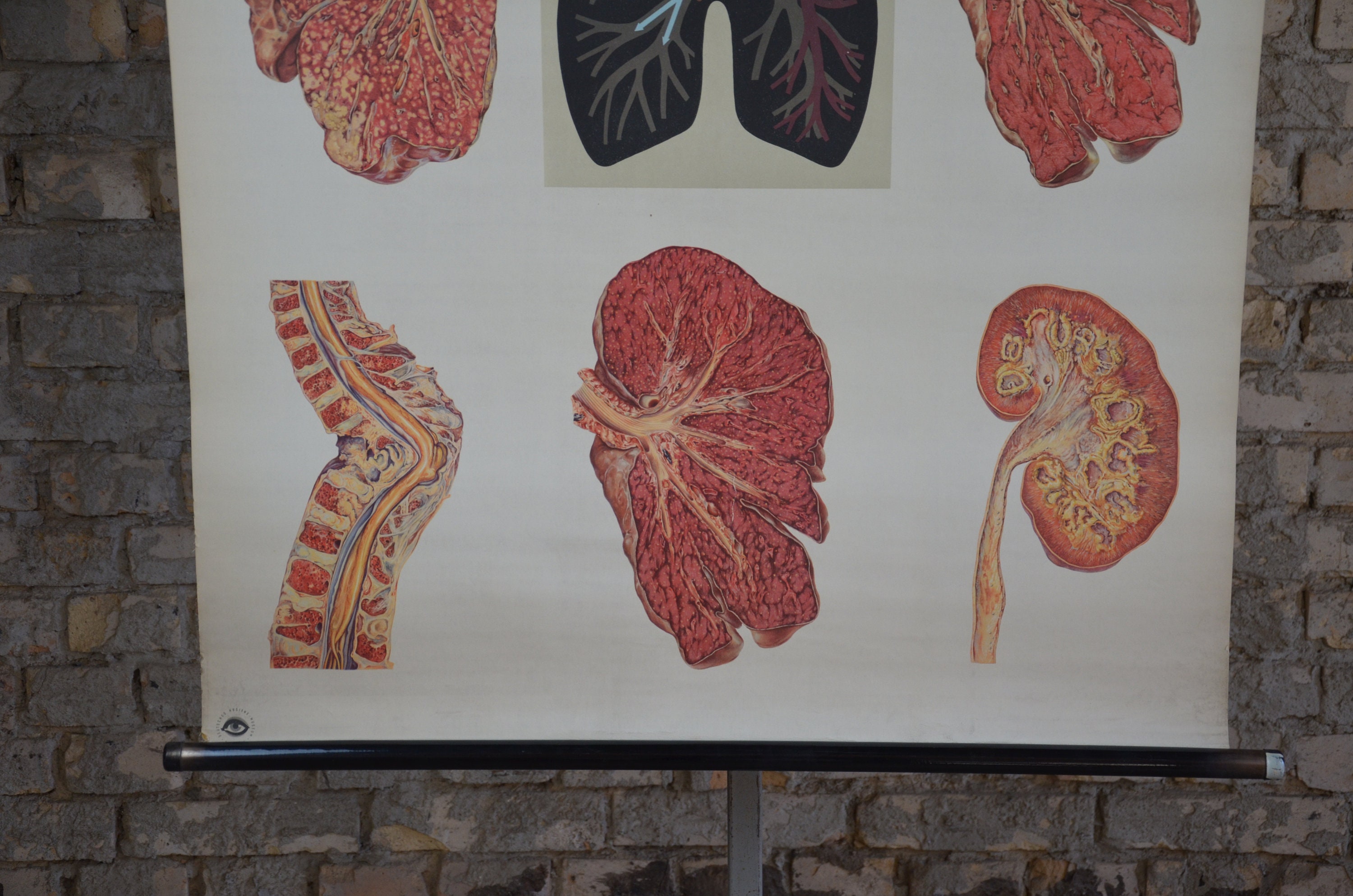 Lung Tuberculosis, Respiratory Organs, Human Anatomy: Original Vintage ...