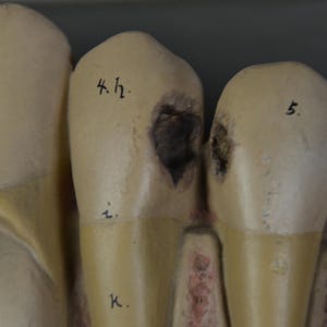 Human Teeth: Vintage Anatomical Model Original SOMSO Anatomy 1950s ...