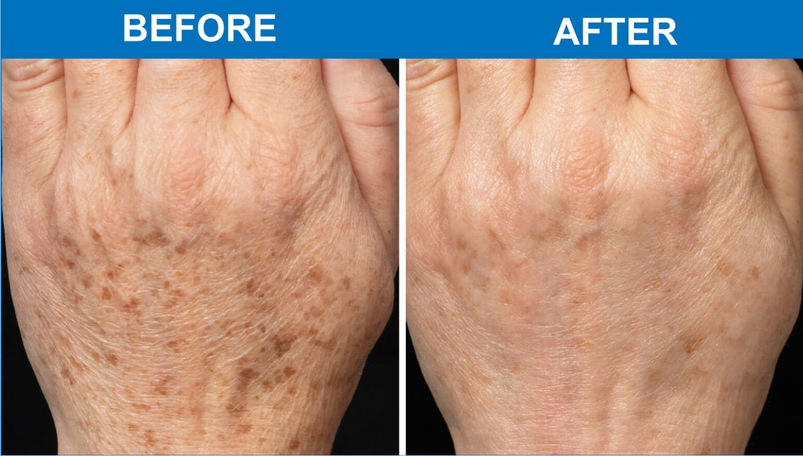 Tca Peel 15 Wrinkles Fine Lines Acne Scars Lip Lines Etsy
