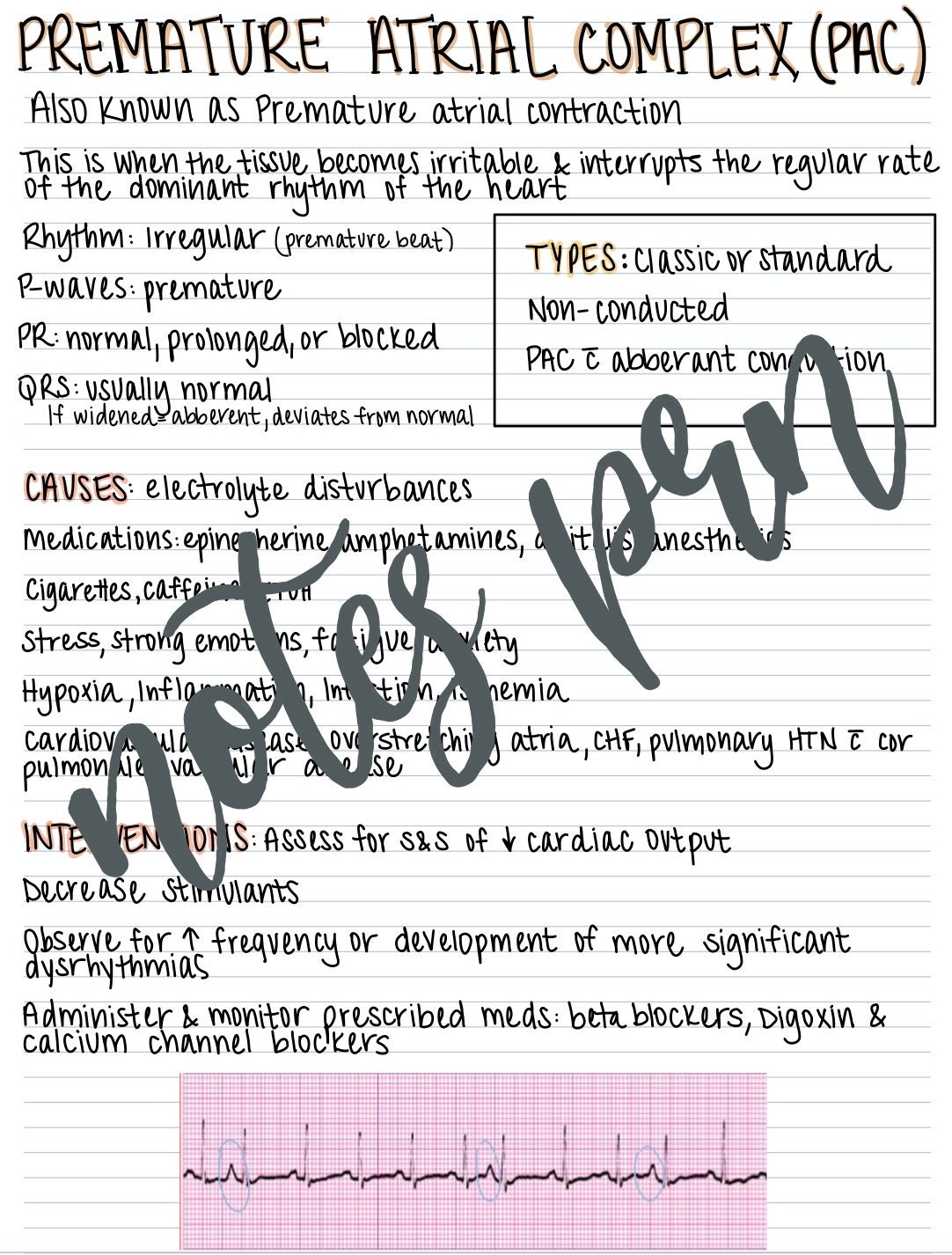 Premature Atrial Contraction