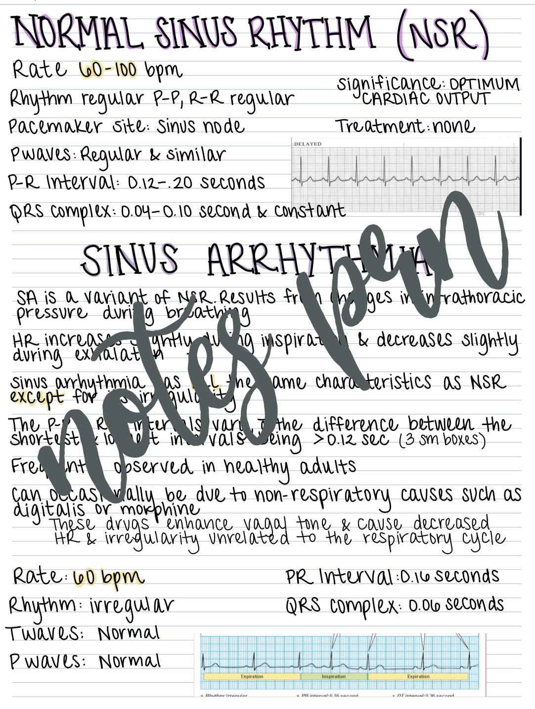 Characteristics Of Sinus Node Arrhythmias