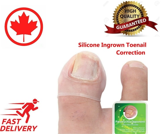 Straightening Clip Brace Ingrown Toenail Correction Tool Toe - Etsy