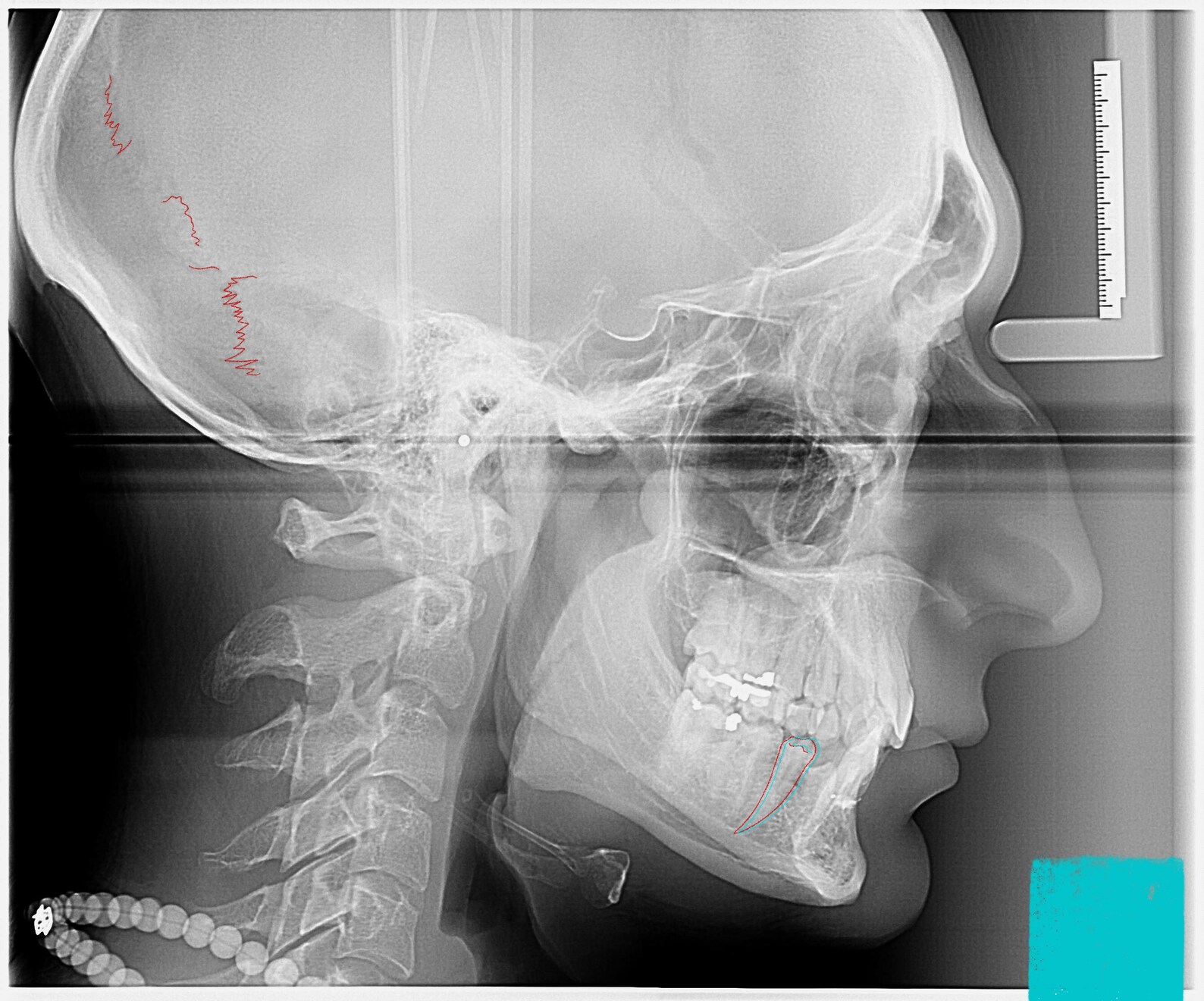 Pearl Necklace X-ray - Etsy