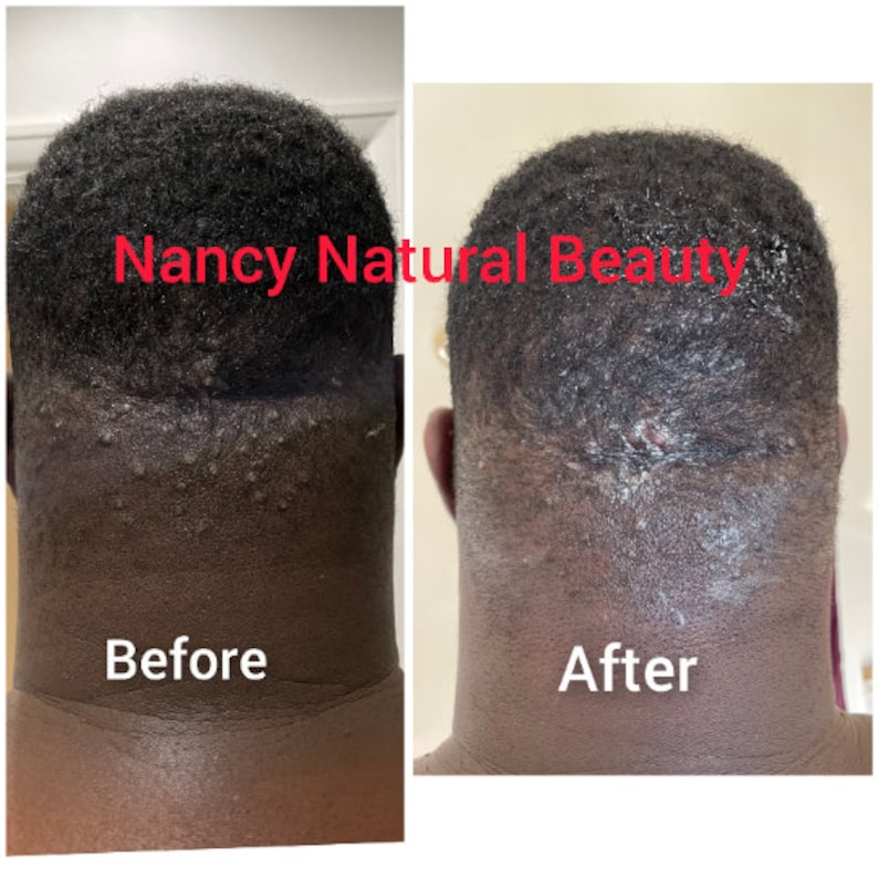 Razor Bumps Stopper Cream razor Bump Stopper - Etsy