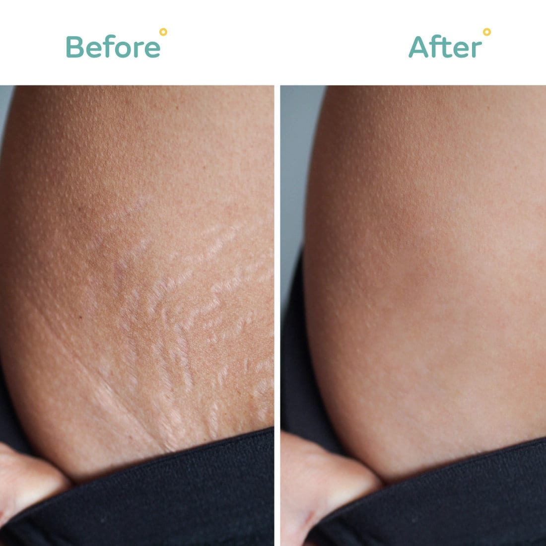 Stretch Mark Oil With Python Oil Scar Remover Oil Stretch - Etsy UK