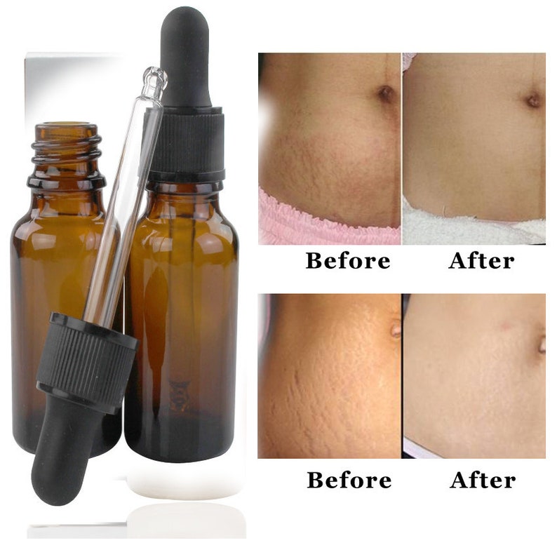 Stretch Mark Oil With Python Oil Scar Remover Oil Stretch - Etsy UK