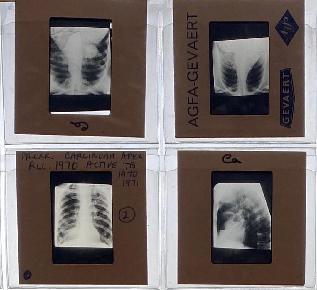 Four Genuine Medical Chest X-ray Slides, Vintage Medical Memorabilia - Etsy